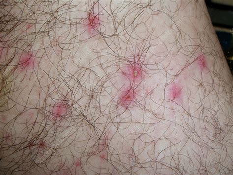 Folliculitis Genital Folliculitis Treatment Advanced Dermatology
