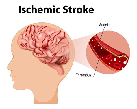 Ischemic Stroke Causes Symptoms Prevention And Treatment