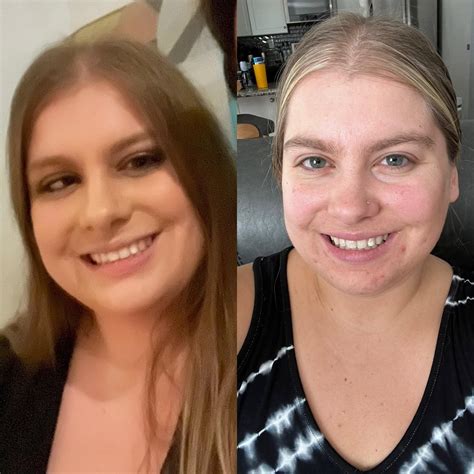 Pre And Post Surgery Pics After Esotropia Surgery Im Six Days Past