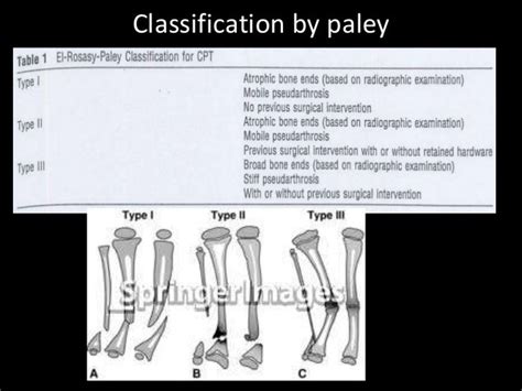 Congenital Pseudoarthrosis Tibia