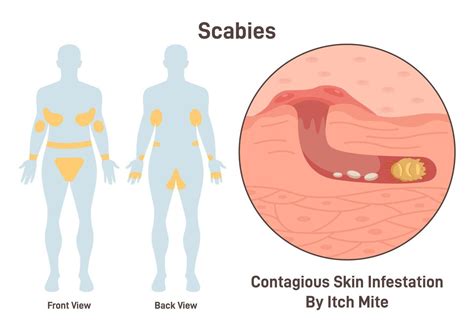 Scabies Skin Infestation With Itch Mite Infected Microscopic