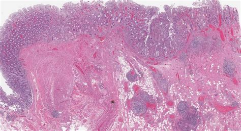 Chronic Ileitis Atlas Of Pathology