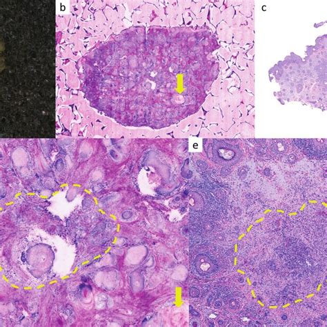 Base Control Of A Nodular Basal Cell Carcinoma Bcc A C Overview Download Scientific