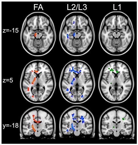 White Matter Changes Between Healthy Controls And Patients First Download Scientific Diagram