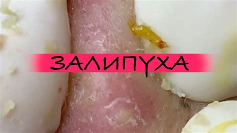 БОЛЬШИЕ ЖИРНЫЕ ПРЫЩИ НА ЛИЦЕ ПРЫЩИ ВЫДАВЛИВАНИЕ ЛЕЧЕНИЕ АКНЕ НА ЛИЦЕ ПРЫЩИ Asmr Relax Acne