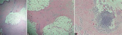Tuberculids A Narrative Review Pmc