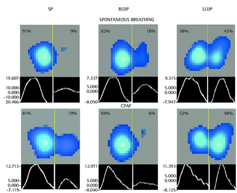 Functional Map Of The Distribution Of Regional Lung Ventilation As Download Scientific Diagram