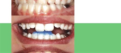 A Voice In The Arena Bite Ramps Part 2 Class 3 Bite Ramps By Dr