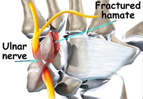 Hook Of Hamate Fracture Hand Orthobullets