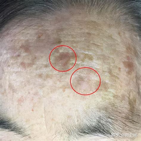 认识容易恶变的 老年斑” 日光性角化病 知乎