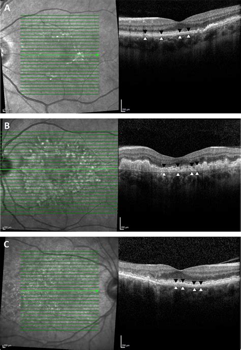 Sd Oct Scans Identifies Distinctive Separation Of The Rpe Black
