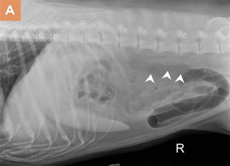 Intussusception X Ray