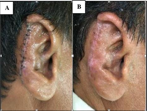 Figure 3 From The Management Of Auricular Defect Using Retroauricular