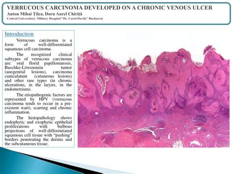 Verrucous Carcinoma Histology