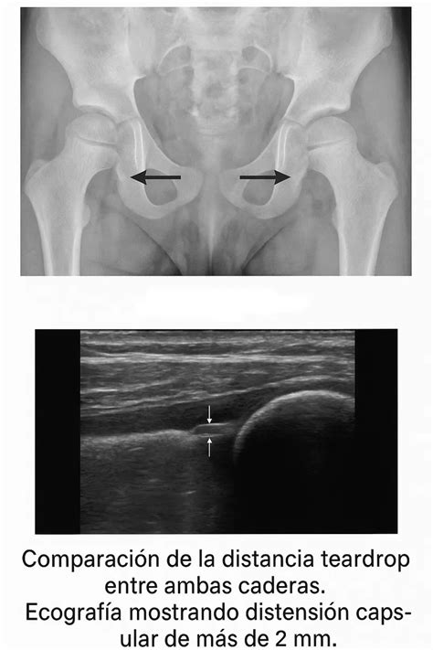 Sinovitis Transitoria De Cadera Síntomas Diagnóstico Y Tratamiento