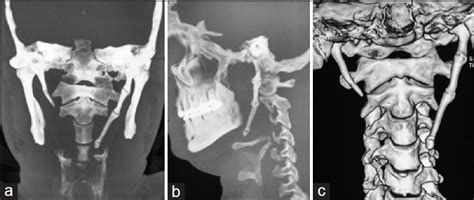 Neck And Head Pain Relief With Uc Care Elongated Styloid Process Aka
