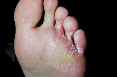 Opiniones De Tinea Pedis