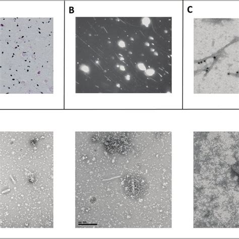 Photomicrograph Of The Locus Niger Showing Two Lewy Bodies Arrows