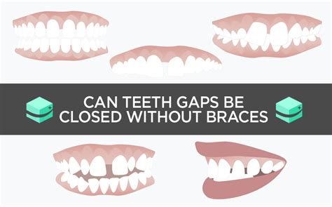 How To Close Gap In Teeth Without Braces Teeth Gaps Can They Be