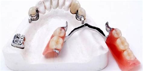 Precision Attachment Partial Denture