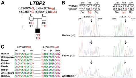 Delineation Of Novel Compound Heterozygous Variants In Ltbp2 Associated