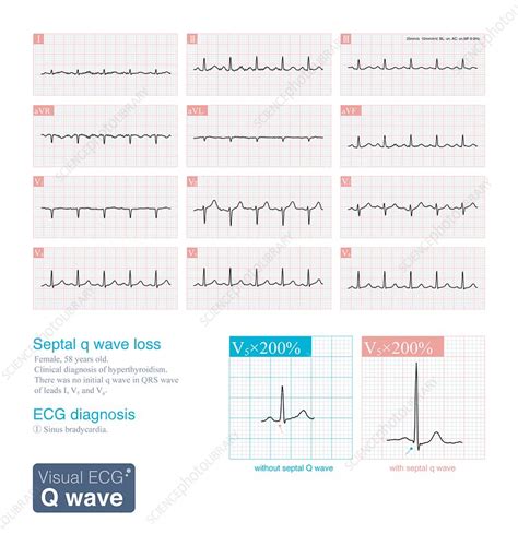 Q Wave Formation