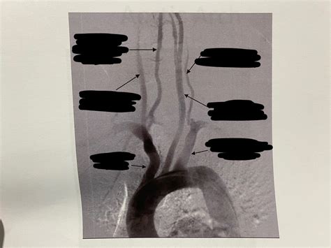Aortic Arch Diagram Quizlet