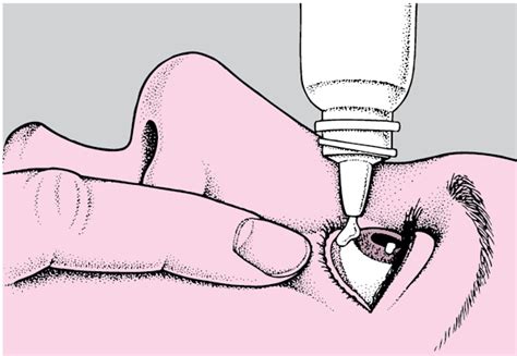 Image Using Eye Drops And Eye Ointments Merck Manual Consumer Version