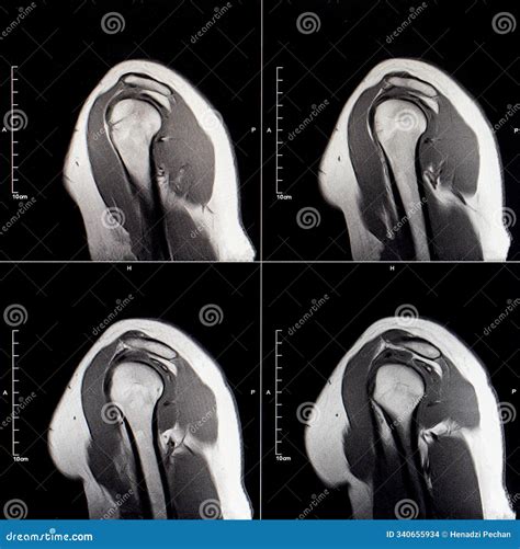 Mri Image Of The Shoulder Joint After A Fracture And Dislocation