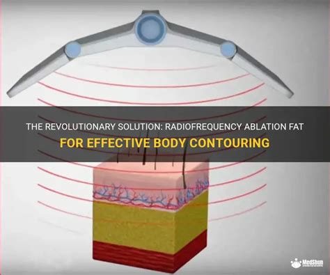 The Revolutionary Solution Radiofrequency Ablation Fat For Effective
