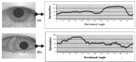 I Different Type Of Eyelids Occlusion In The Iris Portion A Upper Download Scientific