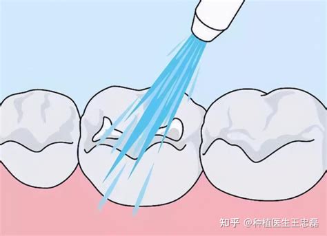 涂氟和窝沟封闭有什么区别？该给孩子做哪一个？ 知乎