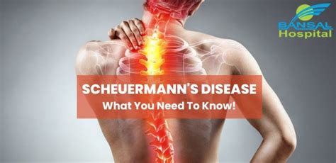 Scheuermanns Disease What You Need To Know Bansal Hospital