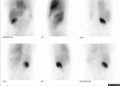 Nuclearmedicine Dmsa Renalscan Ultrasonography Spectct