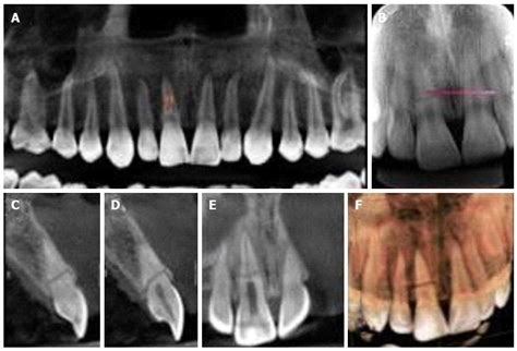 Tooth Root Fracture Xray At Maria Brewster Blog