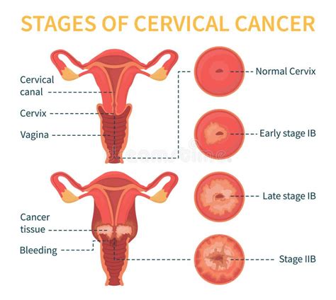 Cervical Ectropion Stock Illustrations 5 Cervical Ectropion Stock