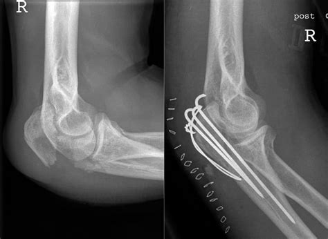 Olecranon Fractures Pathophysiology Management Teachmesurgery