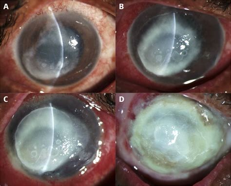 Pythium Insidiosum The Organism That Mimics Fungal Keratitis Community Eye Health Journal
