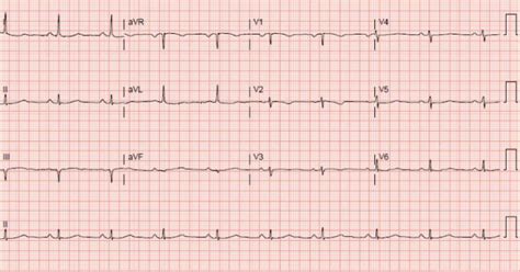 Telemetry And Ekg Basics Rhythm Recognition