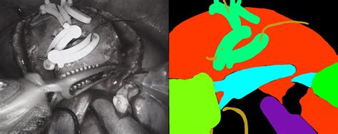 2d semantic segmentation for the improvement of minimally invasive