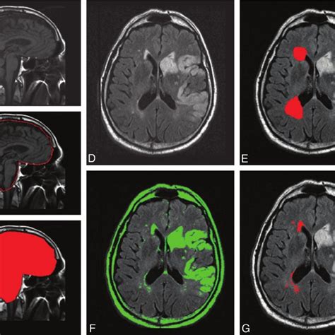 Cta Definition Of Extracranial And Intracranial Large Vessel Stenosis Download Scientific