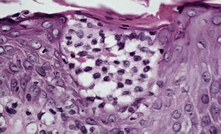 The Spongiotic Reaction Pattern Clinical Tree