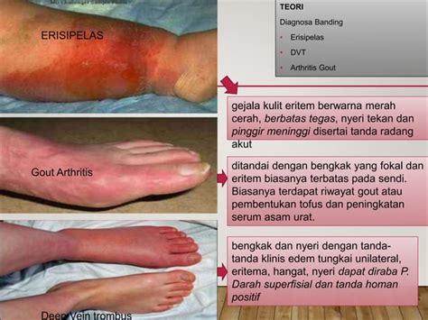 Laporan Kasus Selulitis Rsud Wamena075010 1pptx