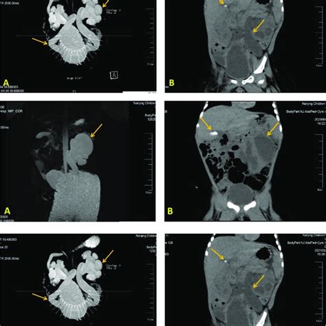 Imaging Modalities And Results Illustrating A Dilated Left Ureter And