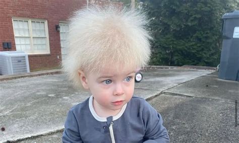 Uncombable Hair Syndrome Amusing Planet