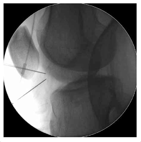 The Lateral Fluoroscopic View Of The Knee Joint With 2 Radiofrequency Download Scientific