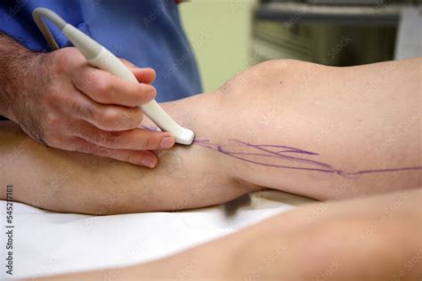 Preparing The Patient For Phlebectomy Surgery Surgical Field Marking