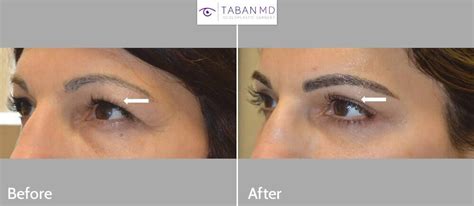 Upper Blepharoplasty Before And After Gallery Taban Md