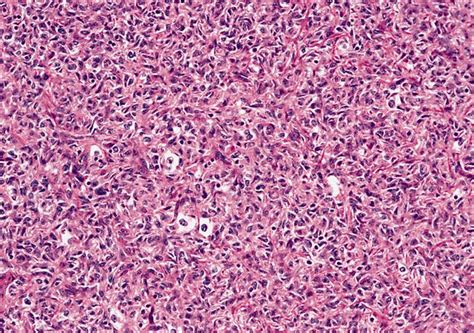 Pathology Outlines Dermatofibroma Cutaneous Fibrous Histiocytoma