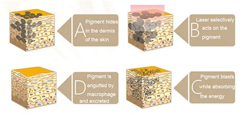 Vertical Q Switched Ndyag Laser Tattoo Removal Machine